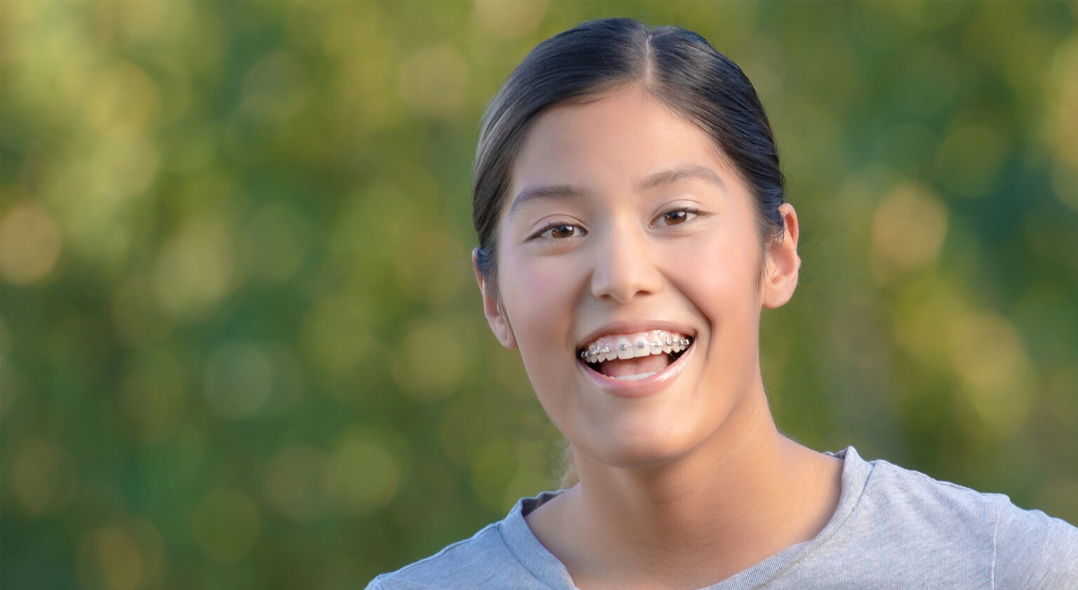 Damon Clear Braces | Clear Braces Foothill | Foothill Invisalign ...